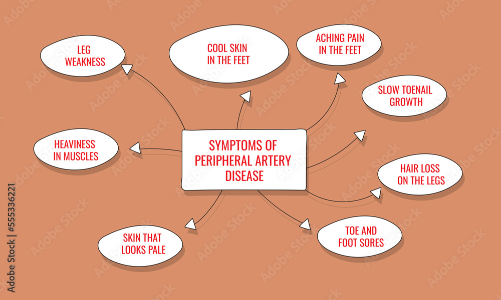 symptoms of Peripheral artery disease. Vector illustration for medical ...