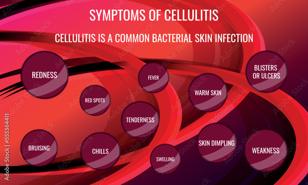 Symptoms of cellulitis. Vector illustration for medical journal or ...