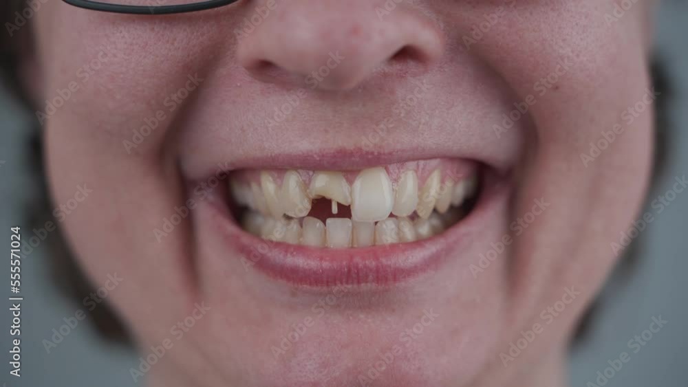 Close-up of smile caucasian woman after front tooth injury. Tooth ...