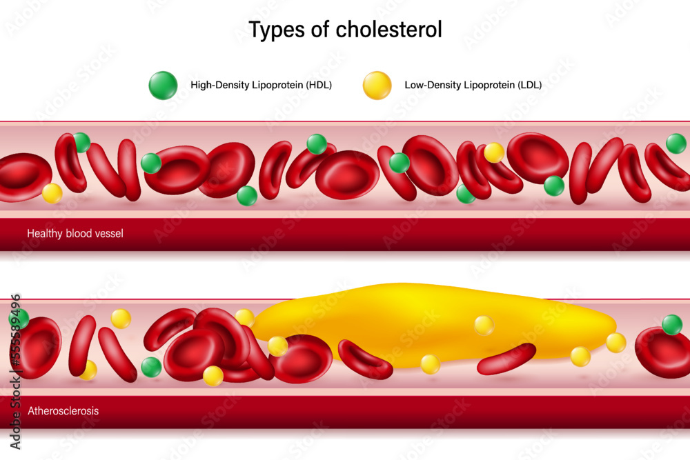 Types of cholesterol. High-Density Lipoprotein (HDL) and Low-Density ... Types of cholesterol. High-Density Lipoprotein (HDL) and Low-Density ...