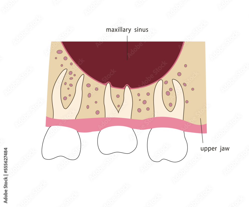 Dental roots in maxillary sinus. Medical illustration in flat style ...