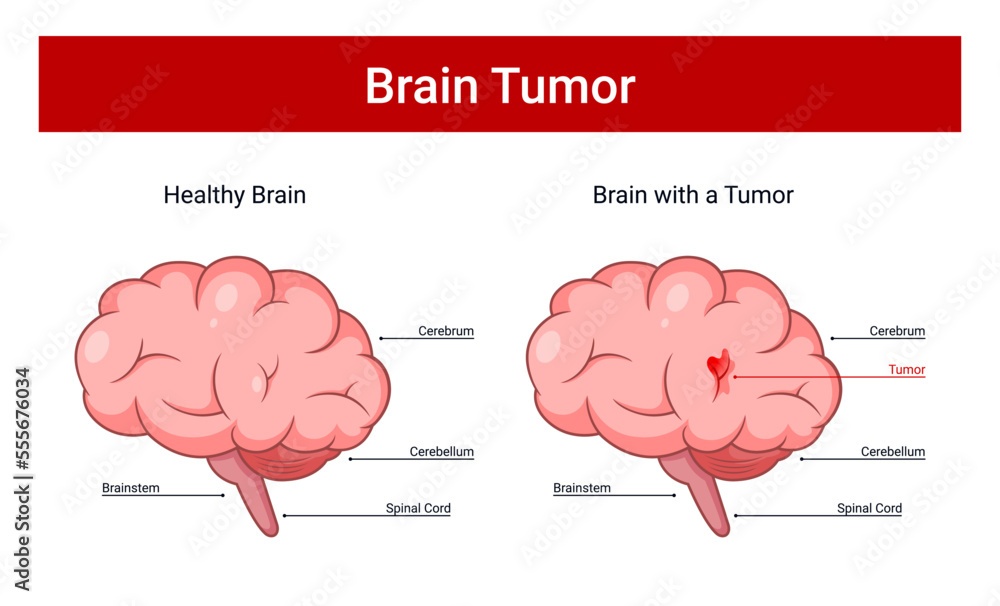 Brain tumor vector diagram, illustration of healthy brain and disease ...