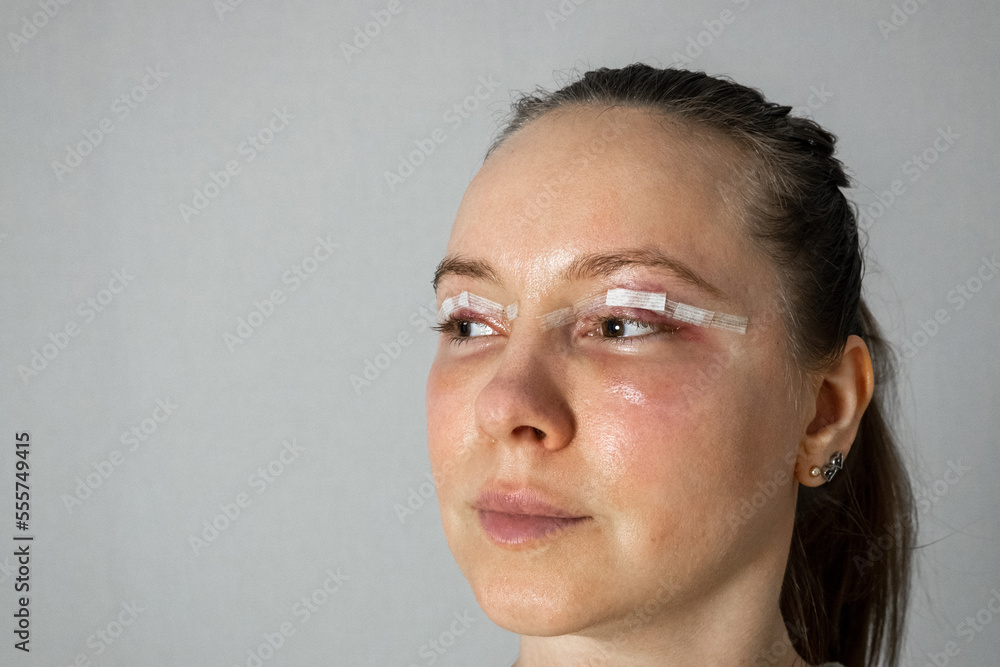 woman face after plastic surgery, blepharoplasty operation, swelling ...
