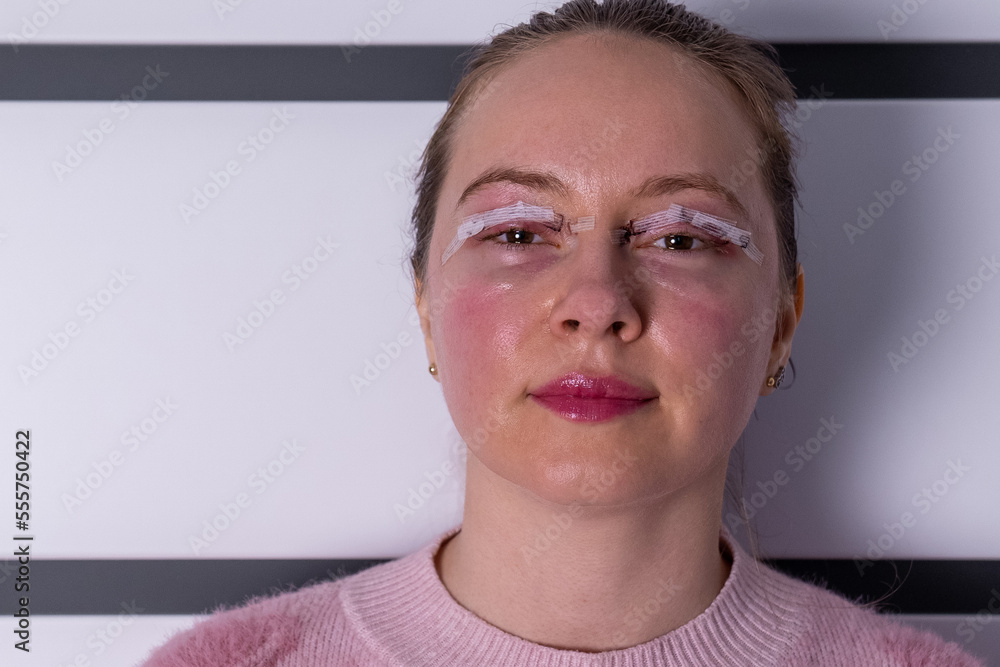 Foto de woman face after plastic surgery, blepharoplasty operation ...