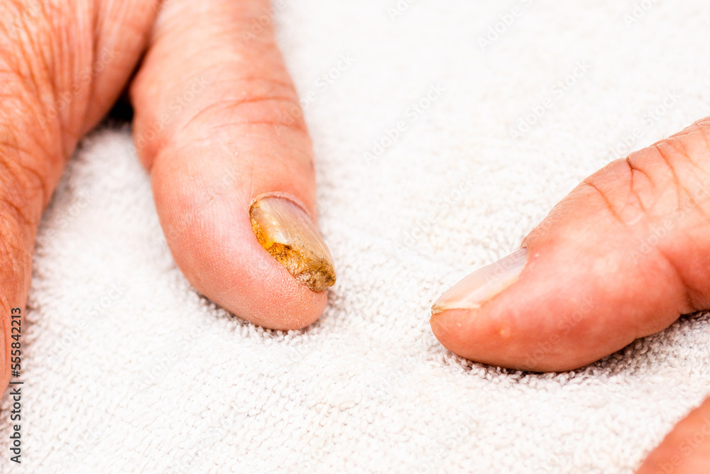 Nail fungus infection on the thumb finger.Fungal infection on nail hand ...