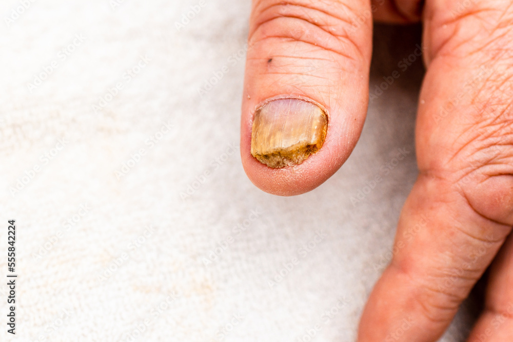 Fungal infection on nail hand,finger with onychomycosis,damage on human ...