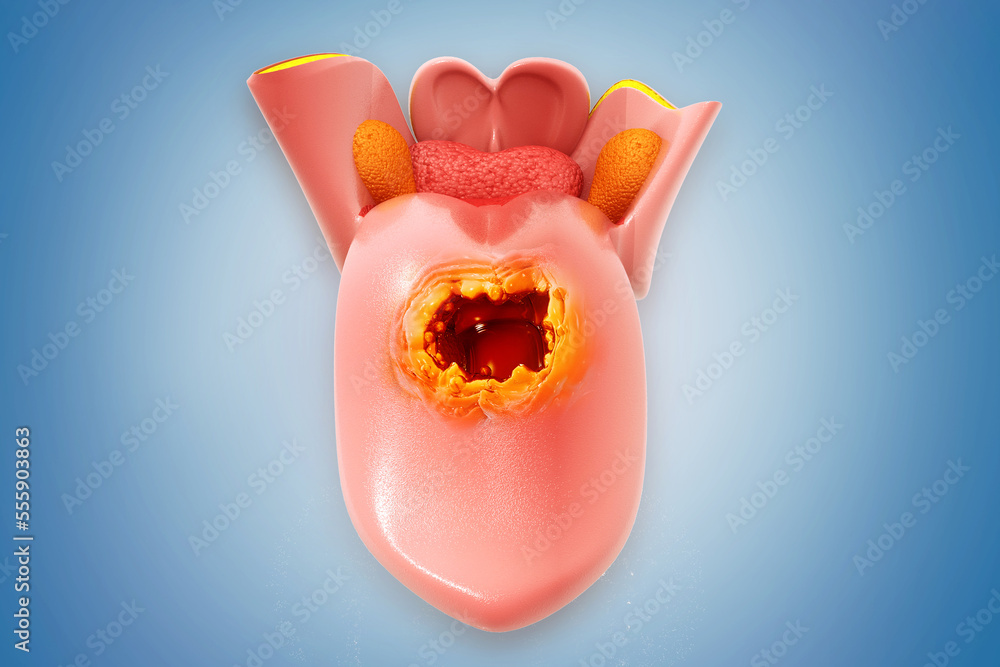 Tongue cancer. medical concept or squamous cell carcinoma as malignant ...