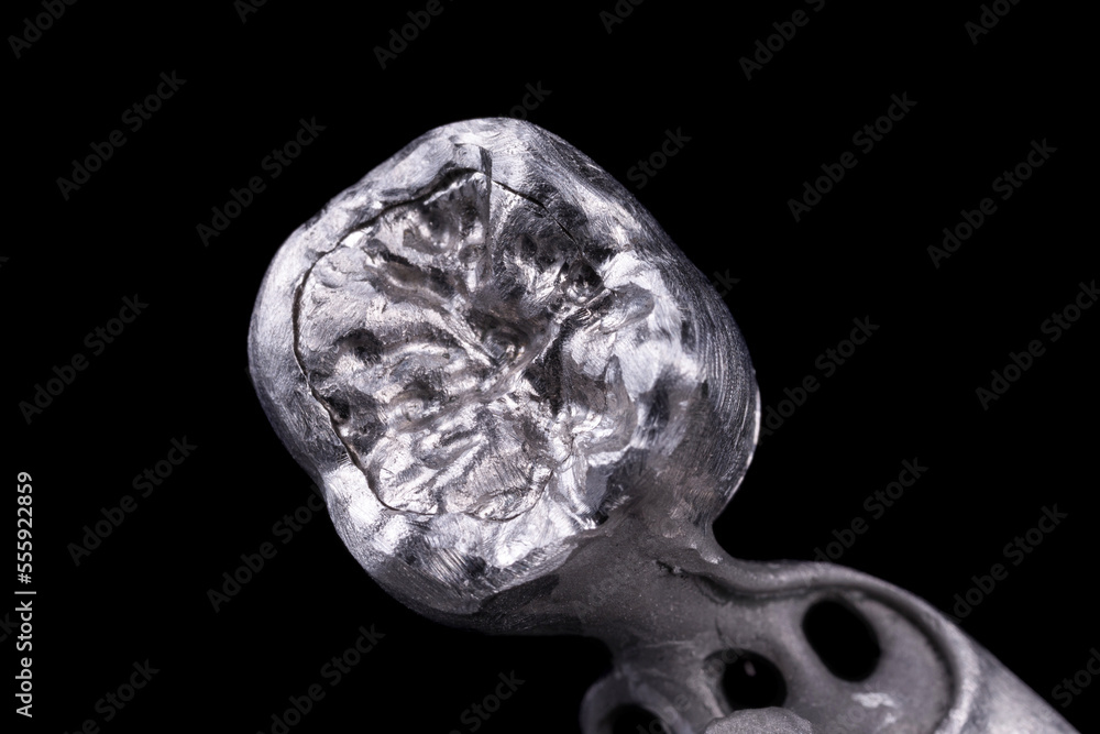 Interlocking metal parts of a crown and a denture with an anatomic ...