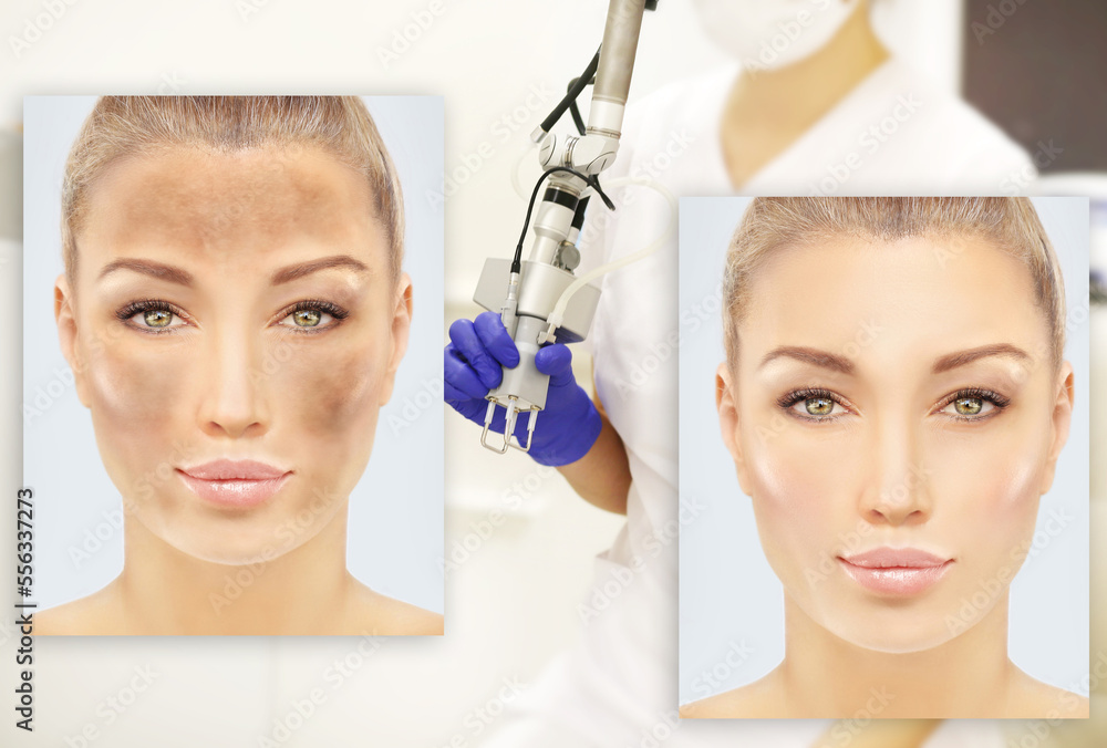 Laser Treatment,Cosmetic Laser Dermatology ,dermatologist offices,Dark ...