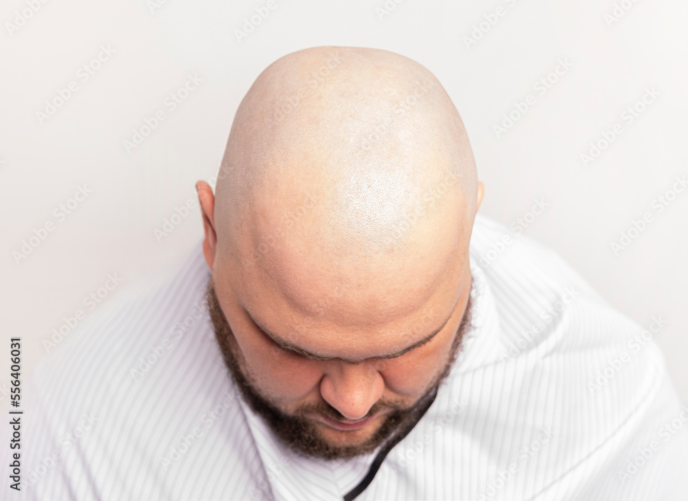 before and after bald head of a man. bald head of a man, shaving bald ...