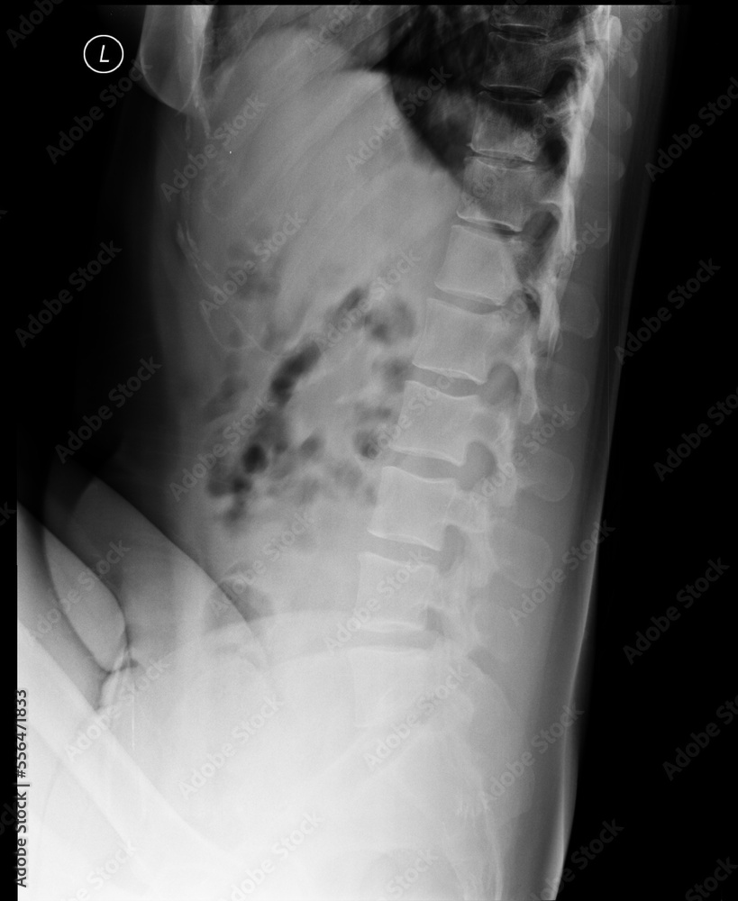 Lumbosacral spine x-ray. Lateral view. Lumbar lordosis with mild right ...