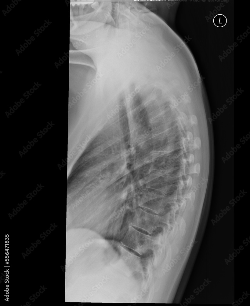 Thoracic spine x-ray. Lateral view. A kyphosis with mild right convex scoliosis around the ...