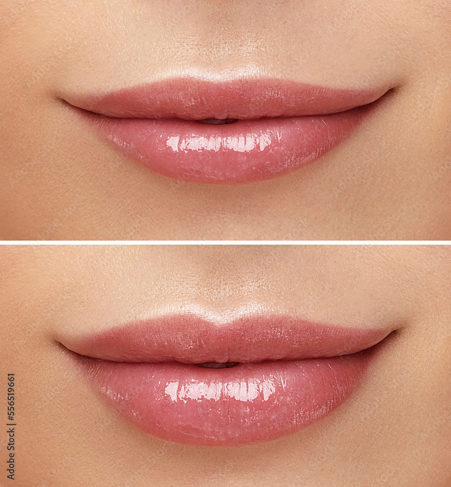 Women lips correction before and after comparison. Hyaluronic acid ...