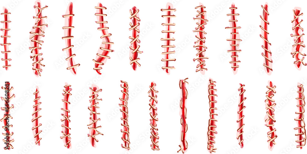 Suture icons set cartoon vector. Wound surgical. Doctor laceration ...