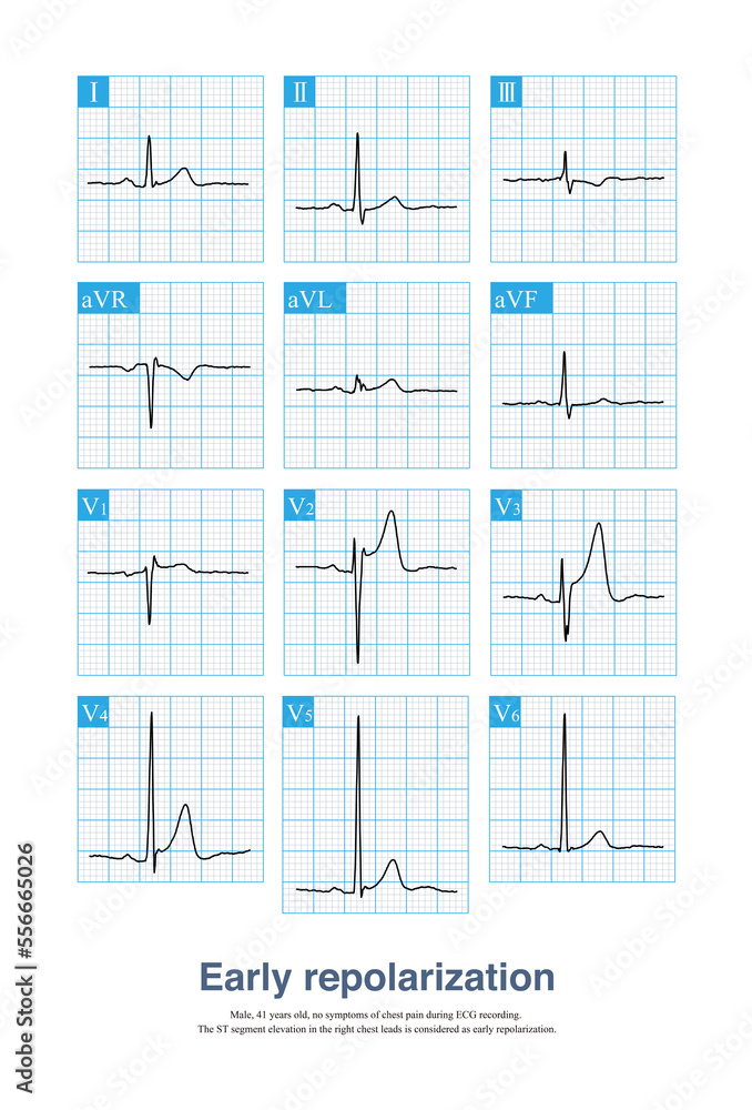 The ECG characteristic change of early repolarization is J point and ST ...