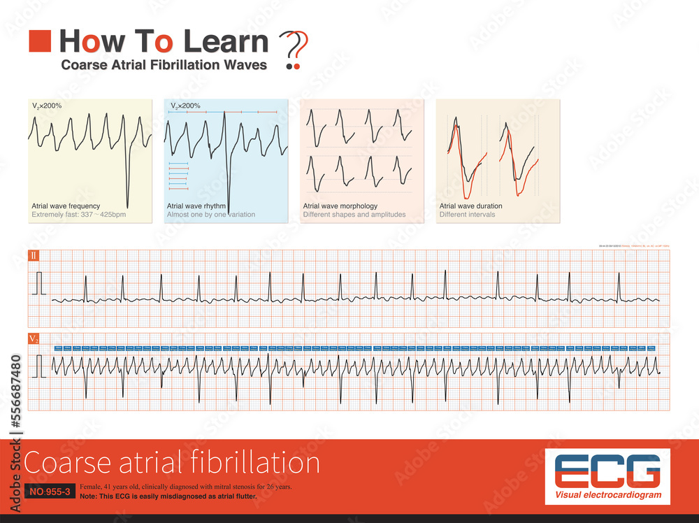 Sometimes, coarse atrial fibrillation is easily misdiagnosed as atrial ...
