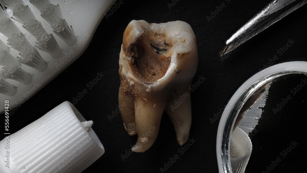 Tooth decay on black background. Macro shot of a decayed teeth till ...