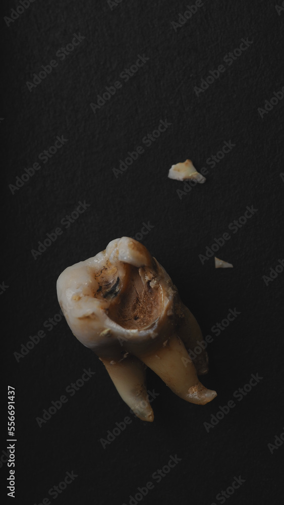 Tooth decay on black background. Macro shot of a decayed teeth till ...