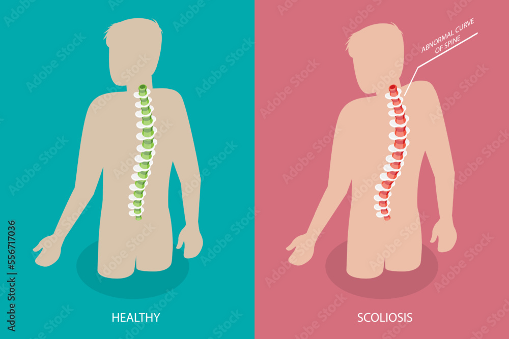 3D Isometric Flat Vector Conceptual Illustration of Scoliosis, Normal ...