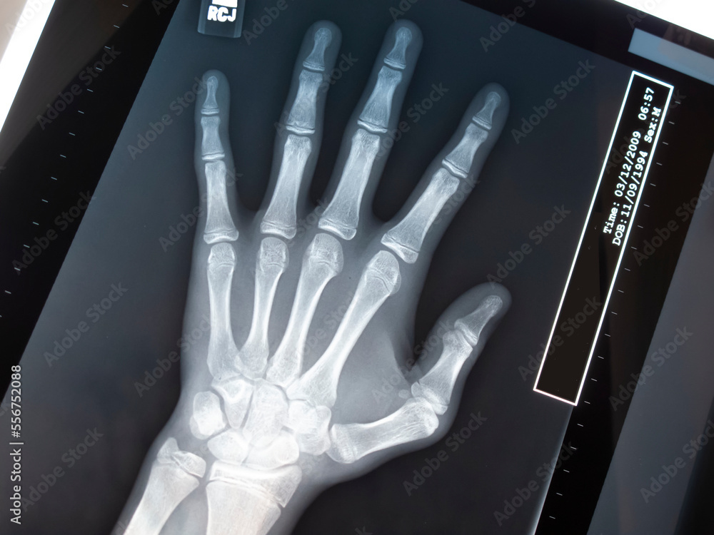 X-ray of a hand and wrist on a scanning bed; Pennsylvania, United ...