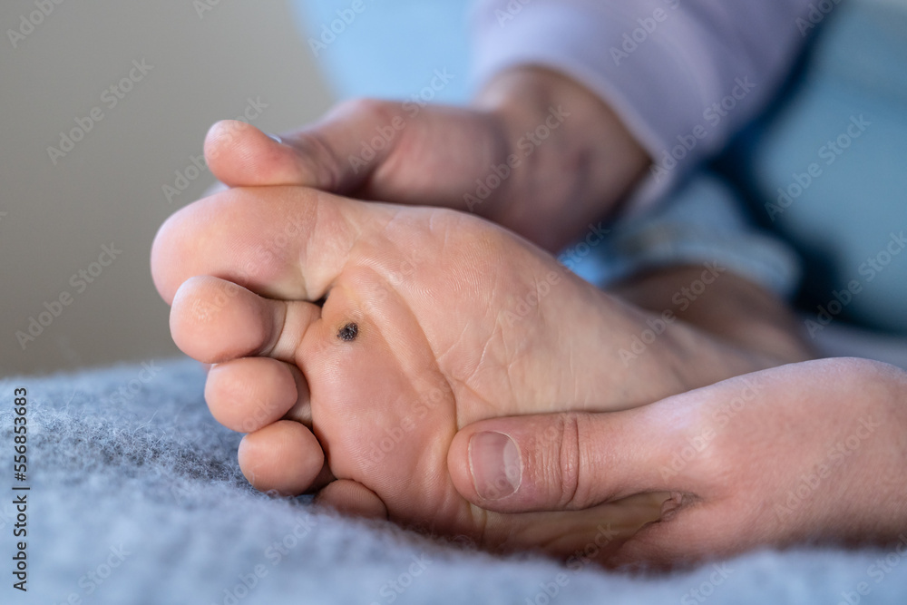 Man checks wart at home after cauterizing it with celandine on infected ...
