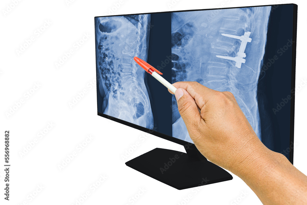 The doctor reported the MRI scans of the lumbar spine compression ...