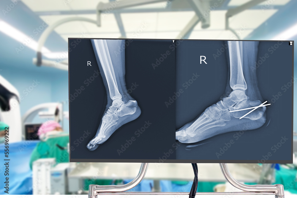 X-ray heel bone fracture(Calcaneus fracture) which is treated by ...
