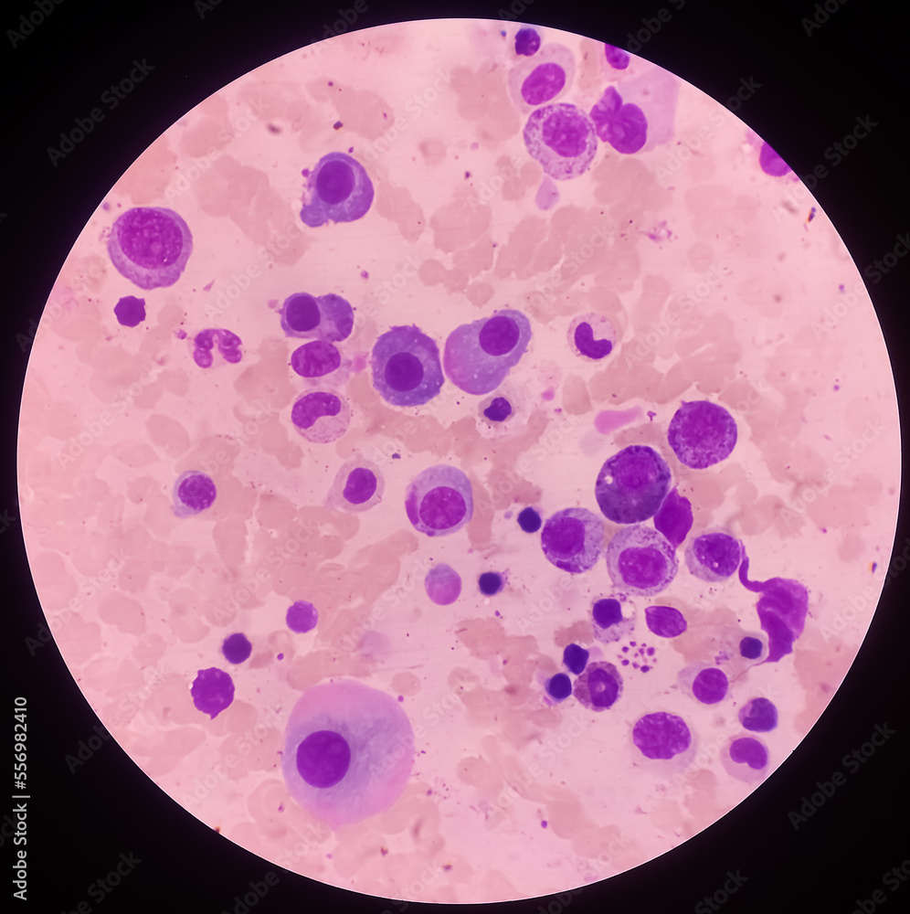 Zdjęcie Stock: Bone marrow study. Plasma cell dyscrasia or Multiple ...