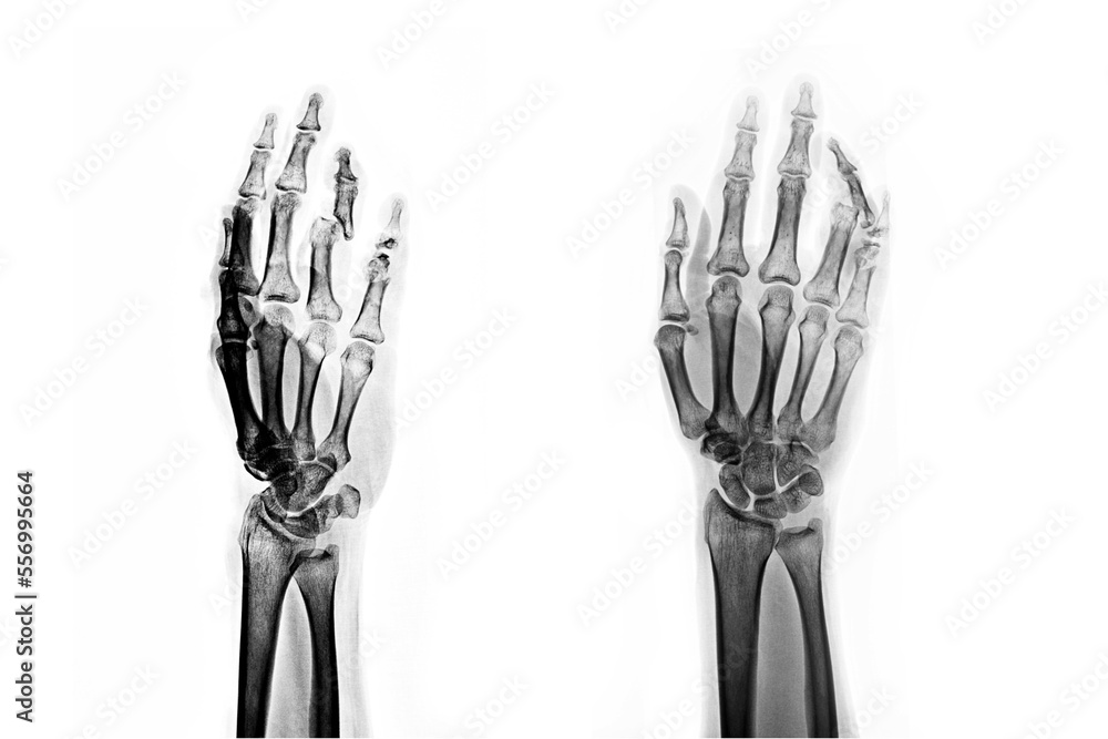 Fracture ring finger and Fracture little finger . Film x-ray AP ...