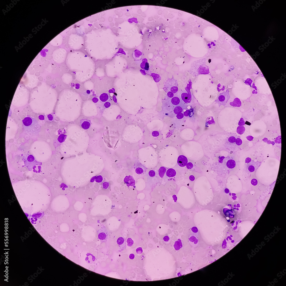 Bone marrow study. Plasma cell dyscrasia or Multiple myeloma. Present ...