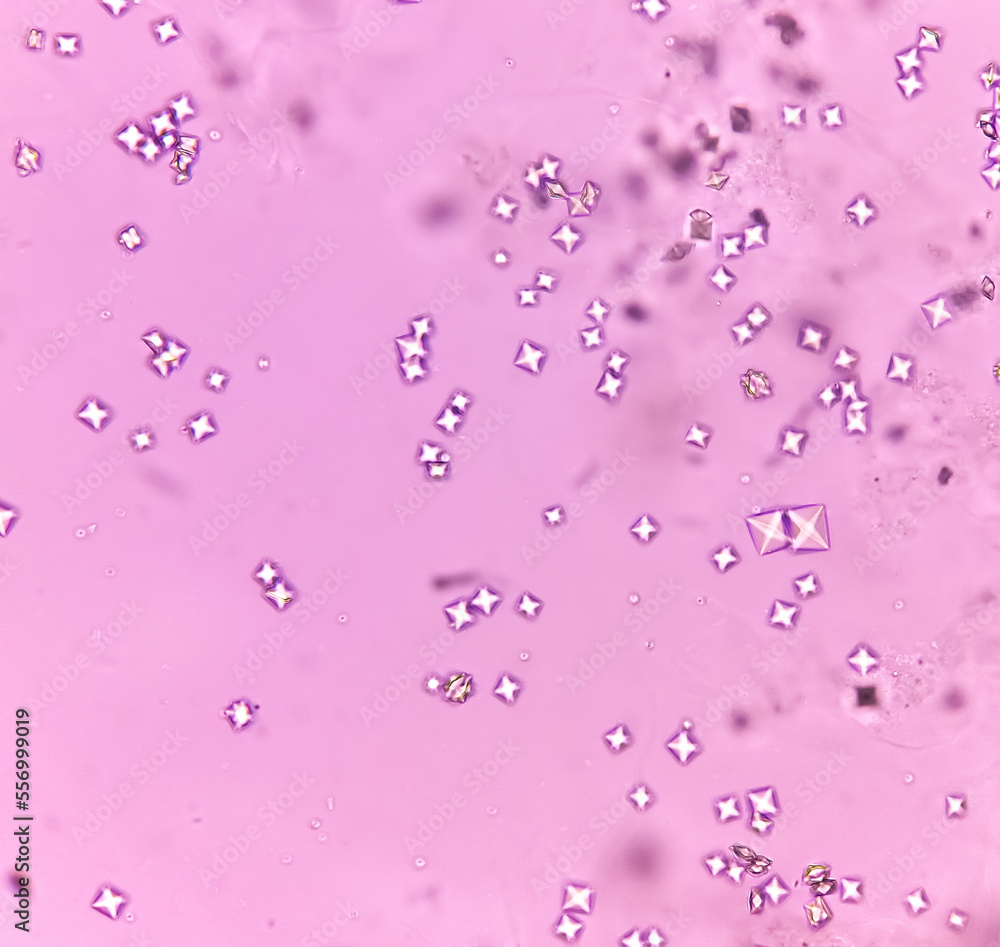 Naklejka Microscopic image showing Calcium oxalate crystals from urine ...