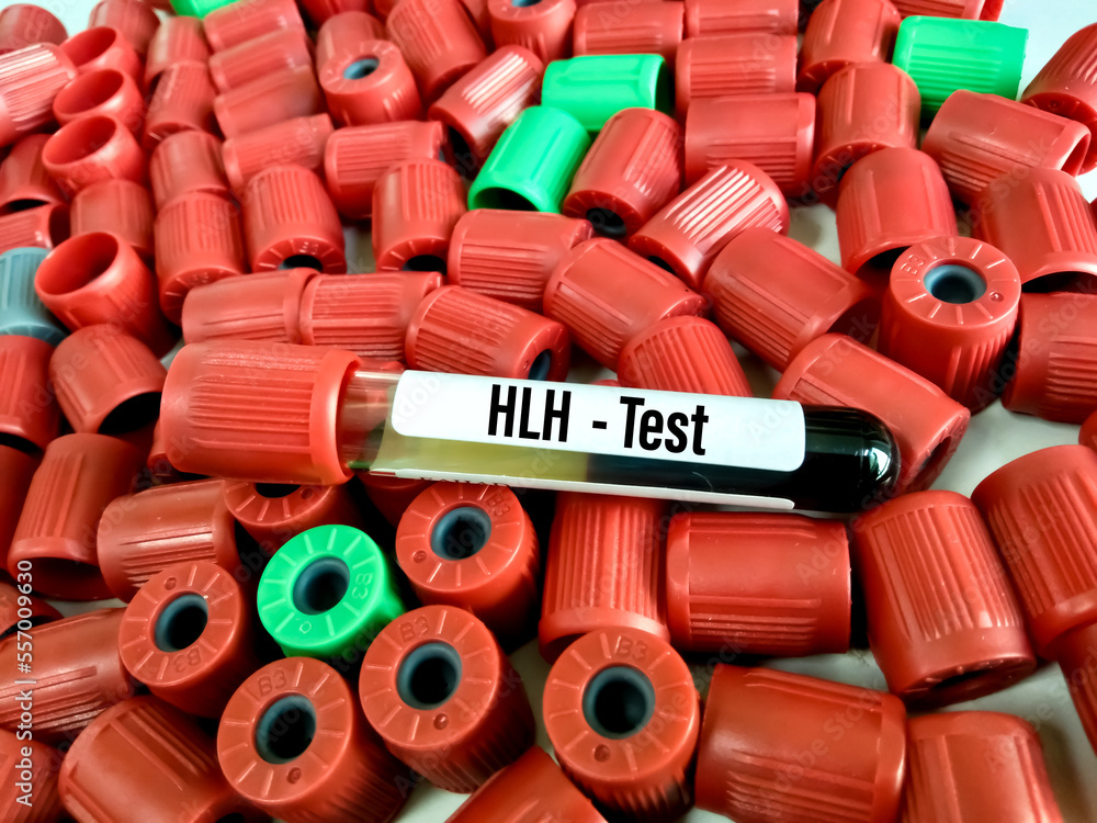 Poster Blood sample for HLH or Hemophagocytic Lymphohistiocytosis, a rare fatal condition in ...