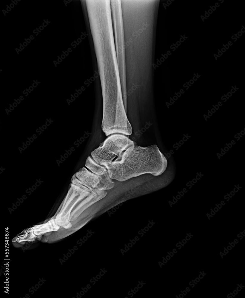 X-ray normal human foot . Lateral view Stock Photo | Adobe Stock