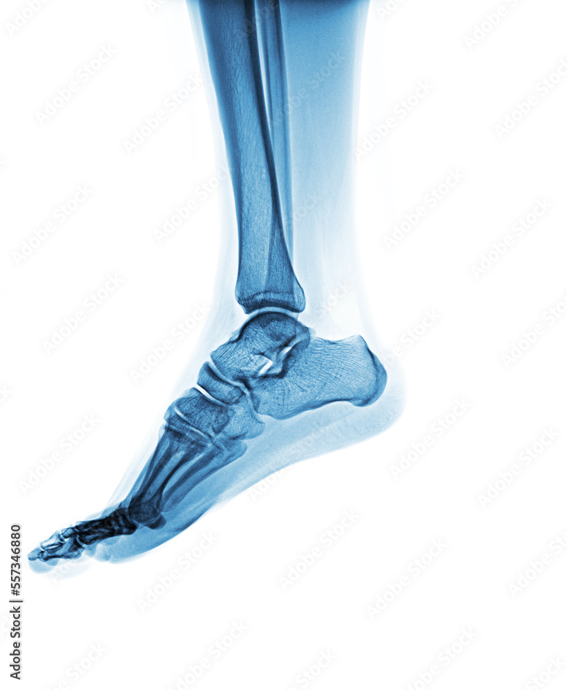 X-ray normal human foot . Lateral view Stock Photo | Adobe Stock