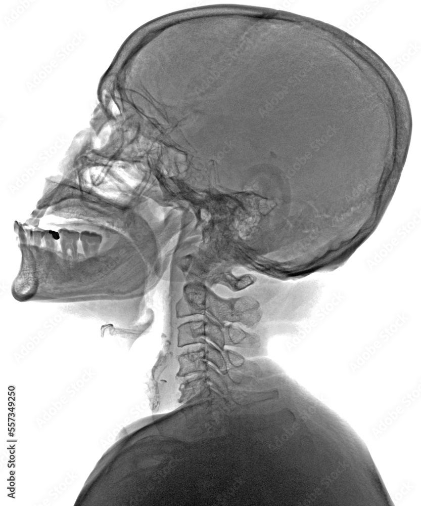 Poster X-ray normal skull and cervical spine . Lateral view . – Wall ...