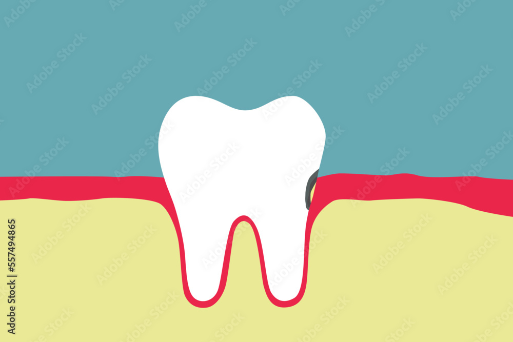 Teeth problem: Plaque is a sticky biofilm that develops on teeth as a ...