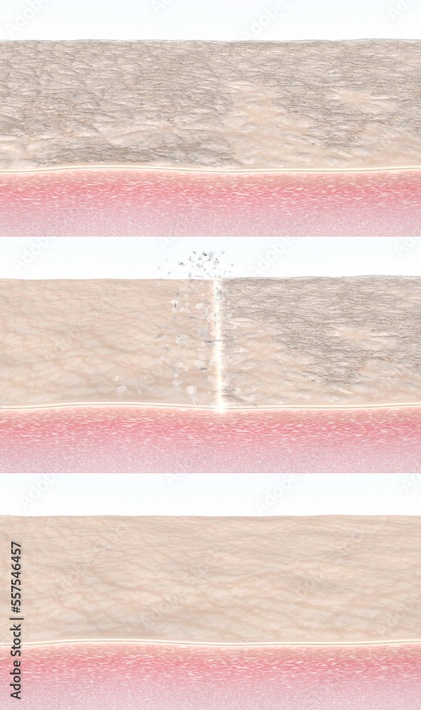 Skin exfoliation. Skin with dry dead cells and impurities before and ...