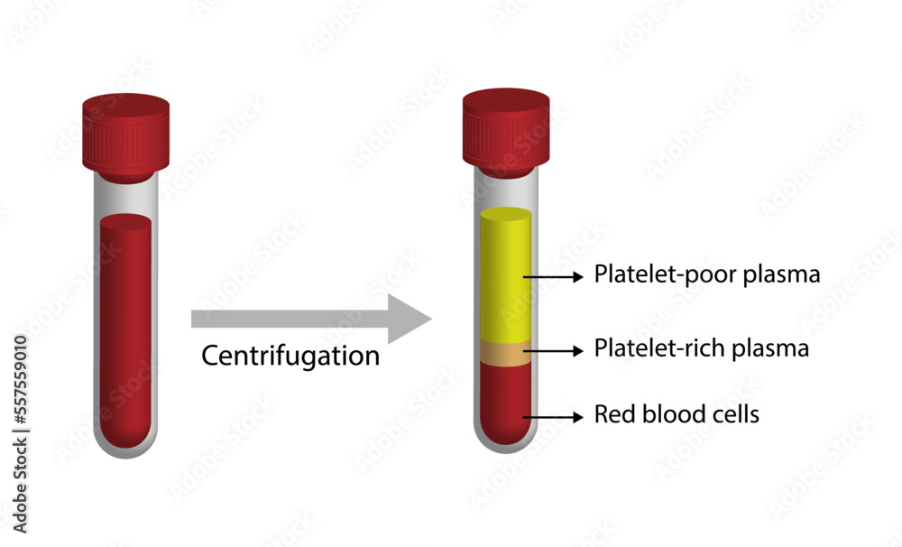 Platelet-rich plasma (prp). Autologous conditioned plasma, is a ...