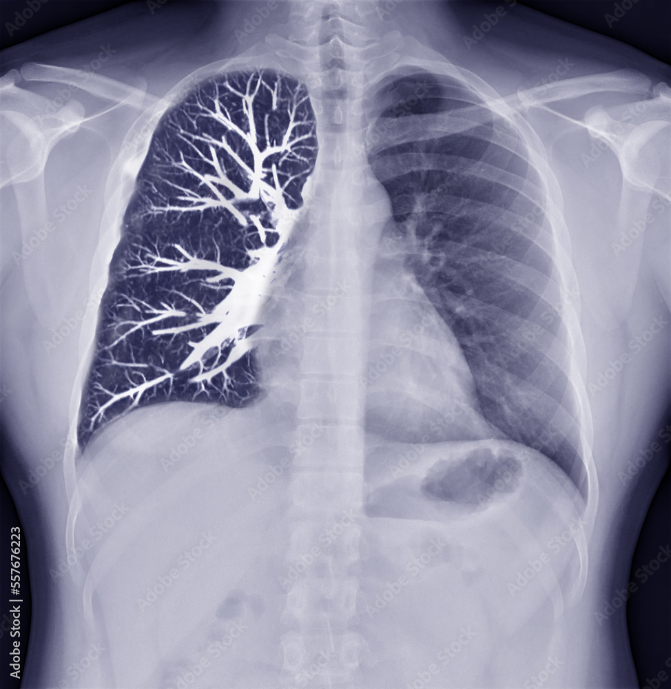 Fusion image of Chest x-ray and CT Chest Coronal view for lung infection from covid-19 Concept ...