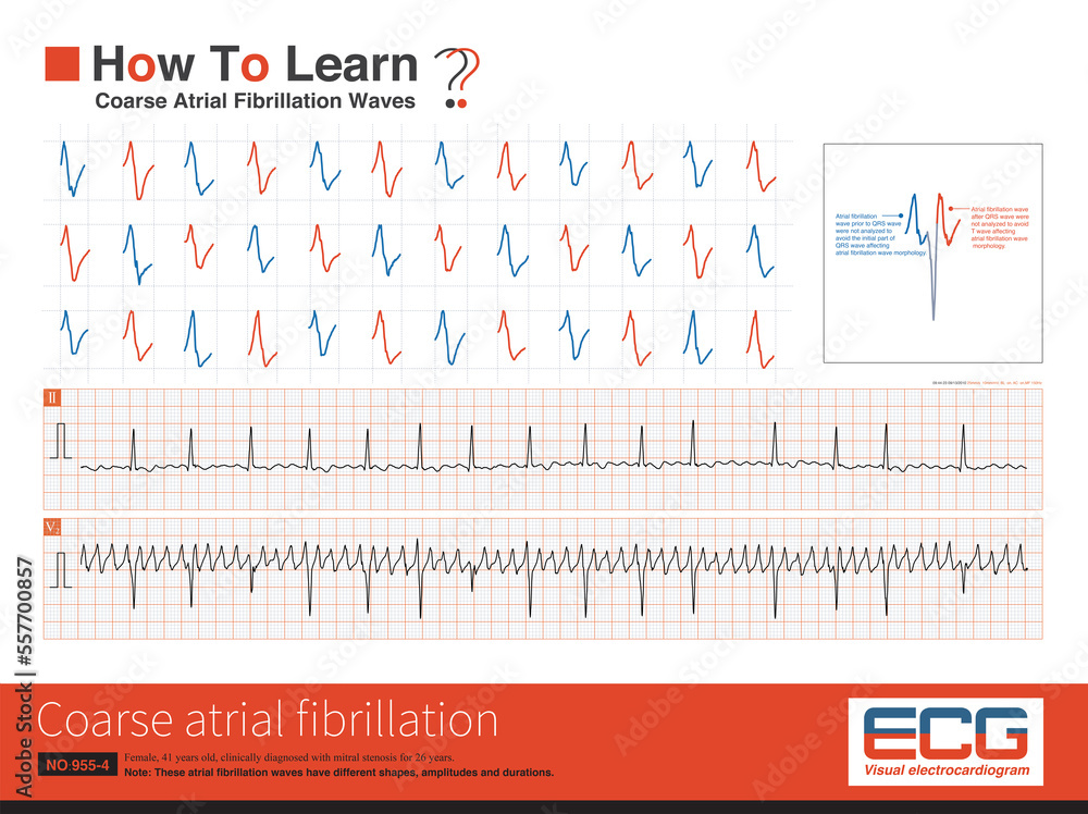 Sometimes, coarse atrial fibrillation is easily misdiagnosed as atrial ...