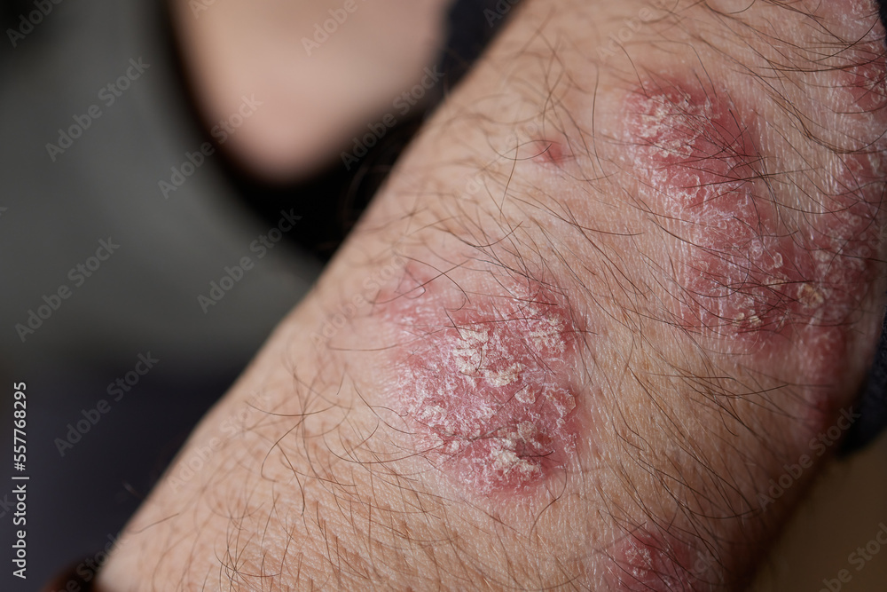 scratch lesion caused by the accident on leg skin. Stock Photo | Adobe ...