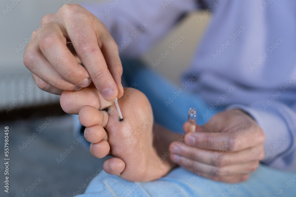 Alternative home treatment of verruca foot. Man applying liquid ...