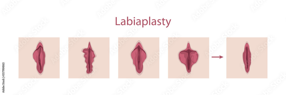 Labiaplasty Stock Vector | Adobe Stock