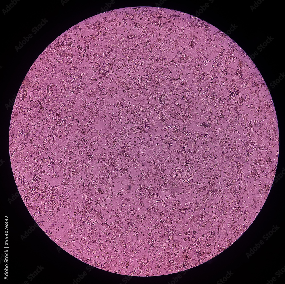 Photomicrograph close view of Abnormal urine analysis under light ...