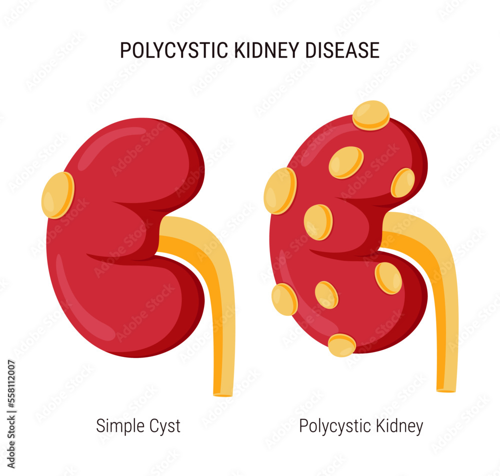 Polycystic Kidney Cyst