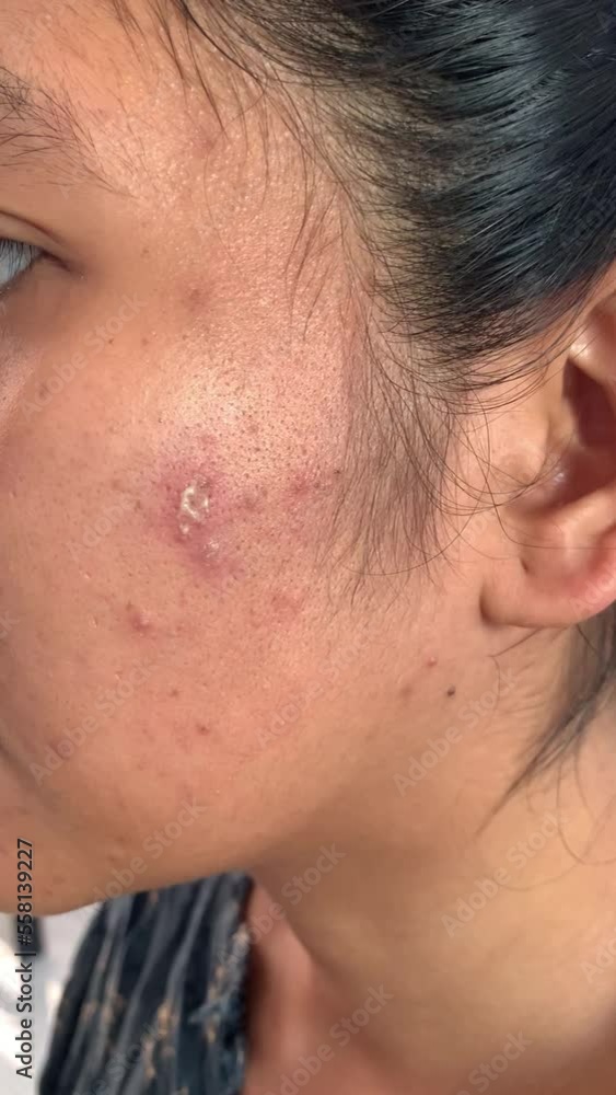 close up of a bare face with breakout face, acne prone skin texture ...