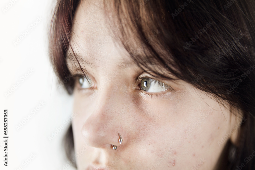 Teen girl face close up, girl has pimples on her face, dry skin and ...