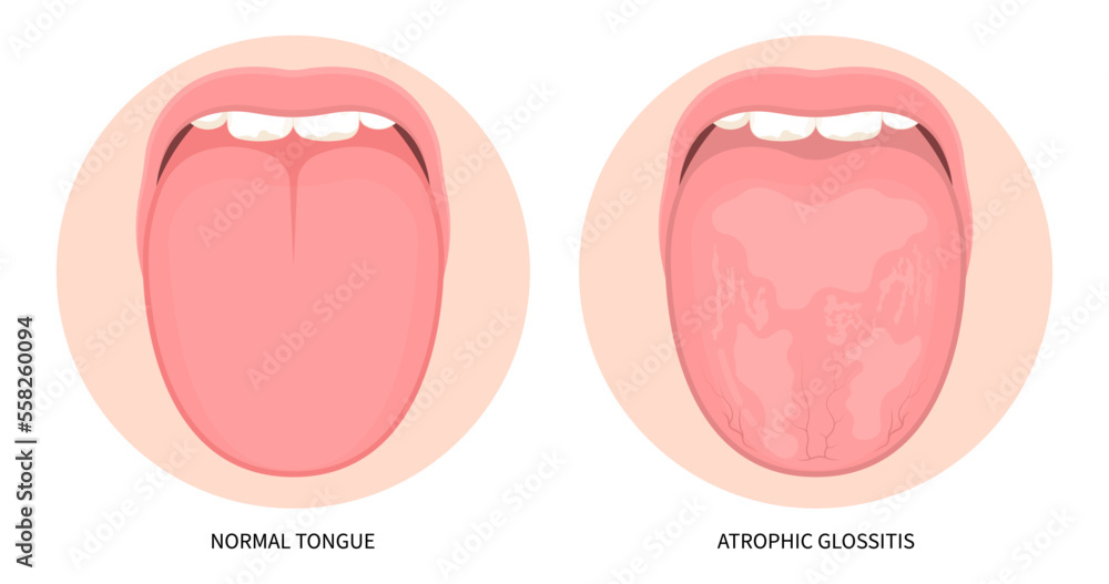 Swelling oral pink throat canker sore in mouth cancer ulcer inflamed ...