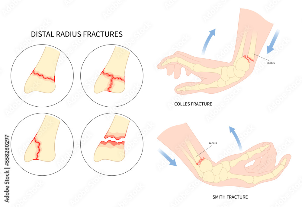 Poster Anatomy hand radial dislocated avascular necrosis displacement ...