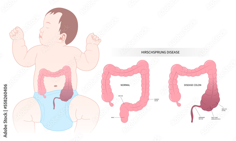 intestinal disease of Hirschsprung's nerves inflammation blocked ...